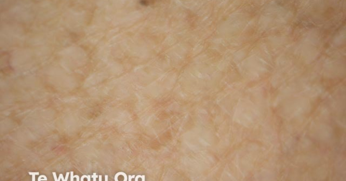 Ichthyosis vulgaris image