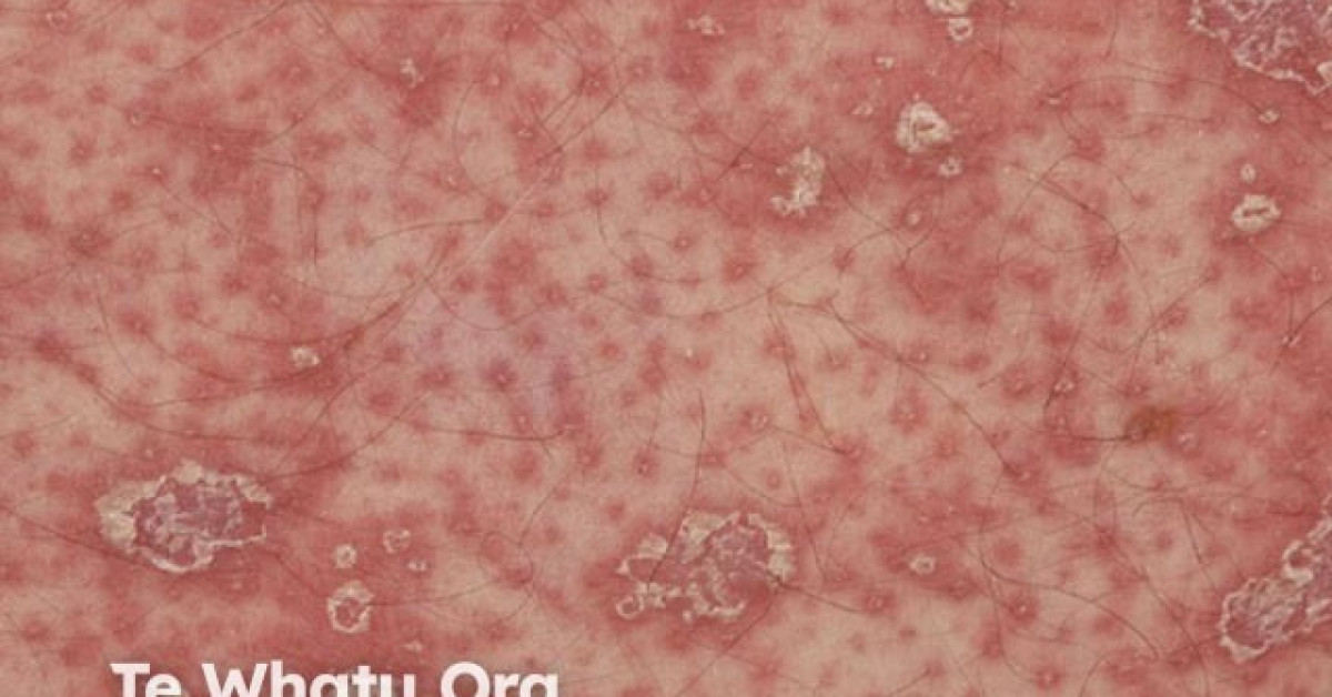 Pityriasis rubra pilaris image