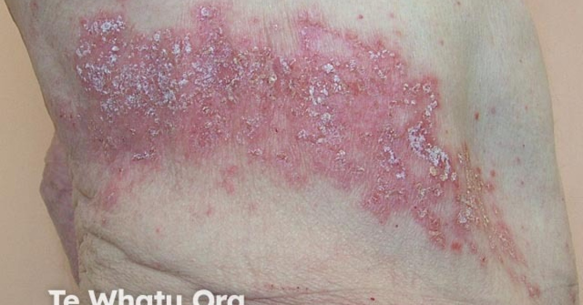 Koebnerised psoriasis following shingles image