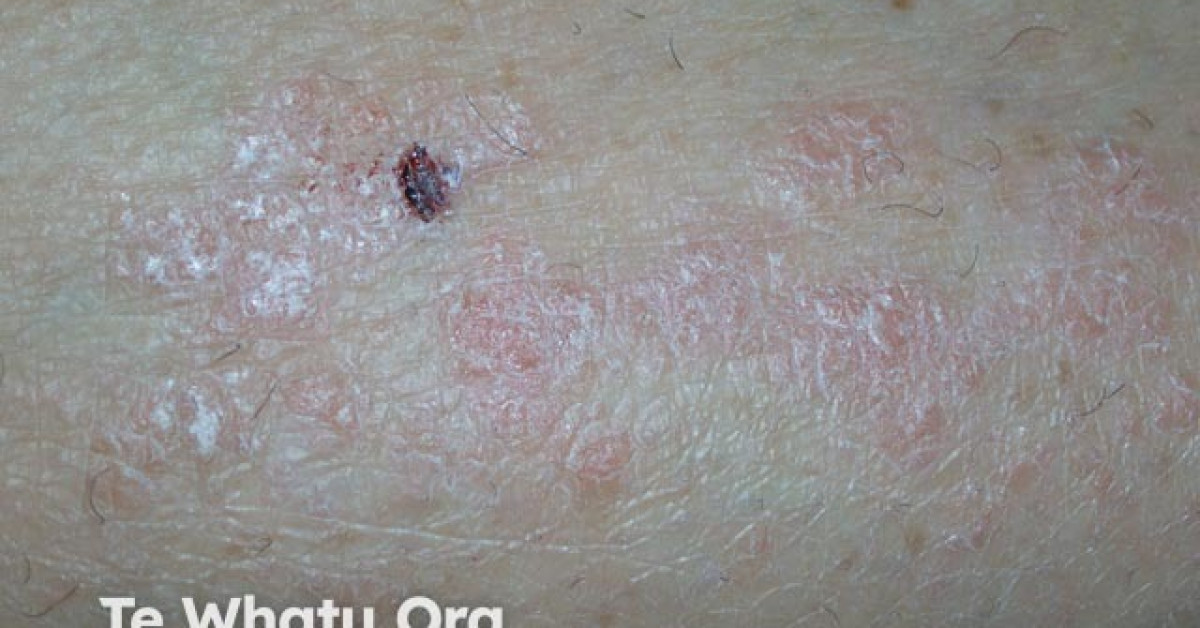 Small plaque psoriasis image
