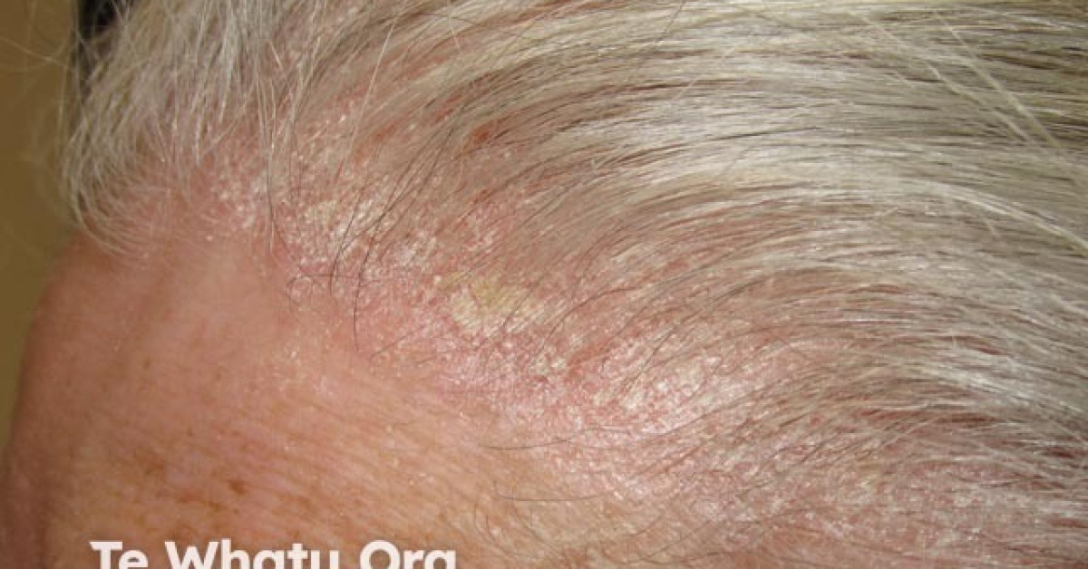 Scalp psoriasis image