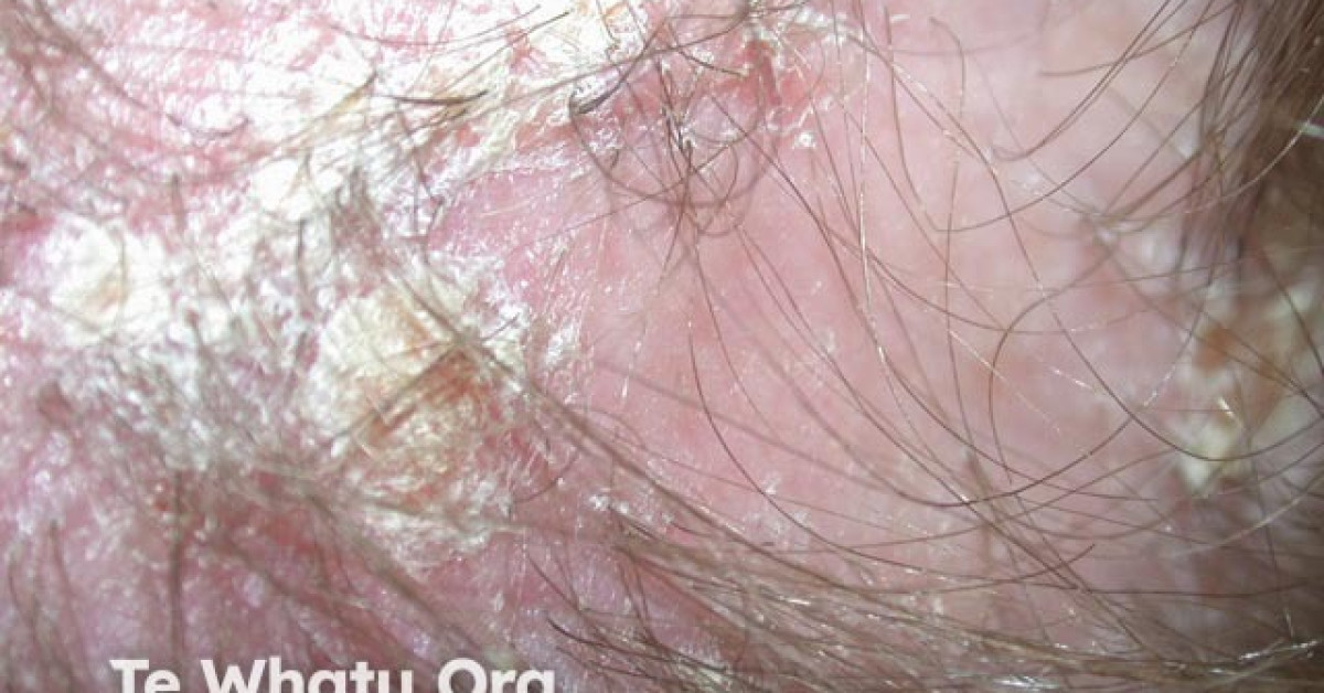 Scalp psoriasis image