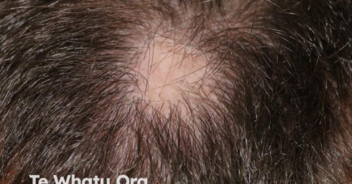 Scalp psoriasis image