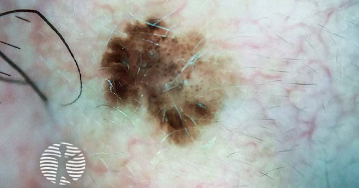 Intraepidermal carcinoma dermoscopy image
