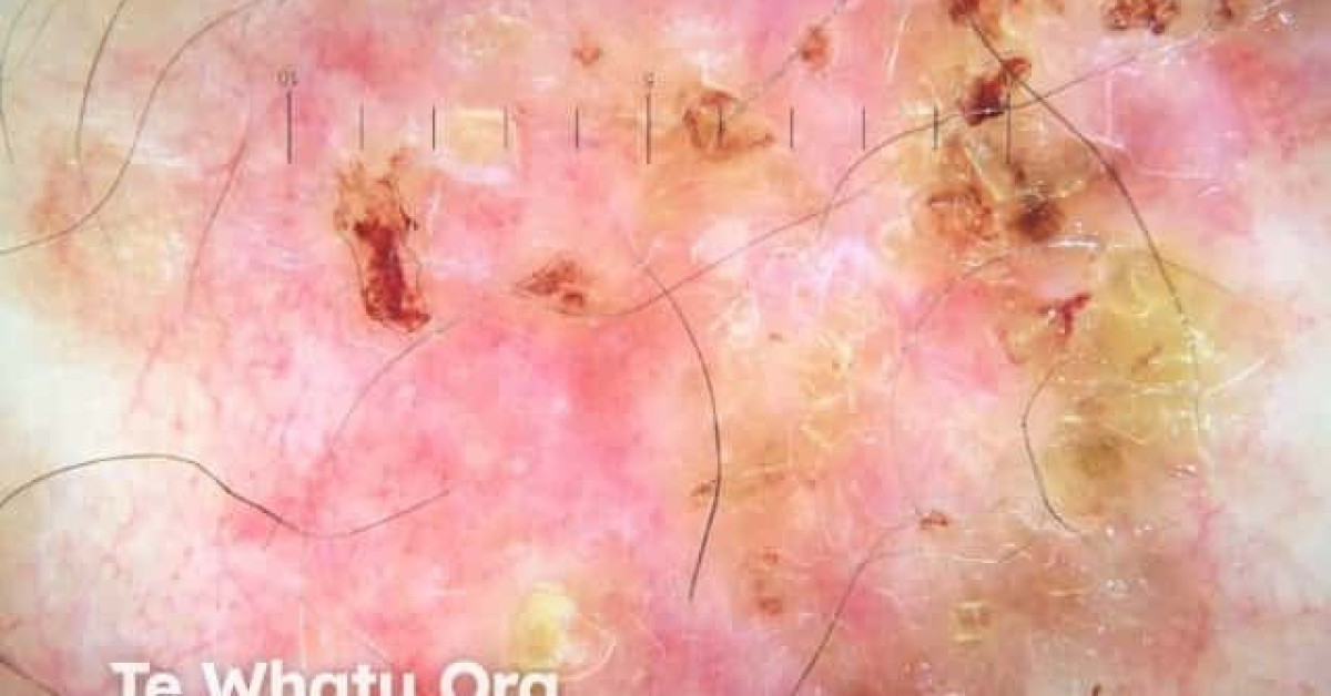 Squamous cell carcinoma in situ image