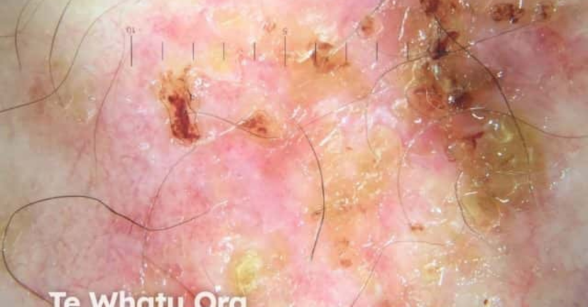 Squamous cell carcinoma in situ image