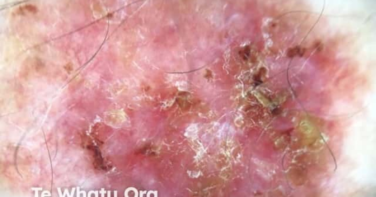 Squamous cell carcinoma in situ image