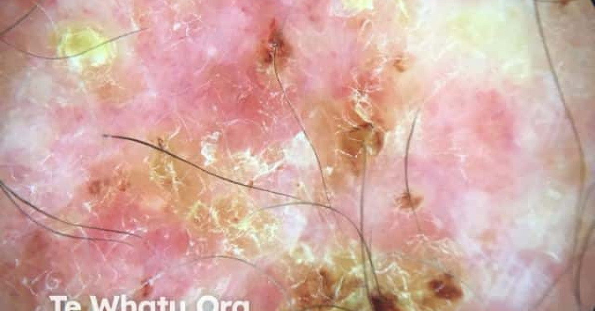 Squamous cell carcinoma in situ image