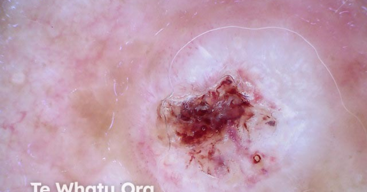 White structureless areas, central keratin and loop vessels in squamous ...