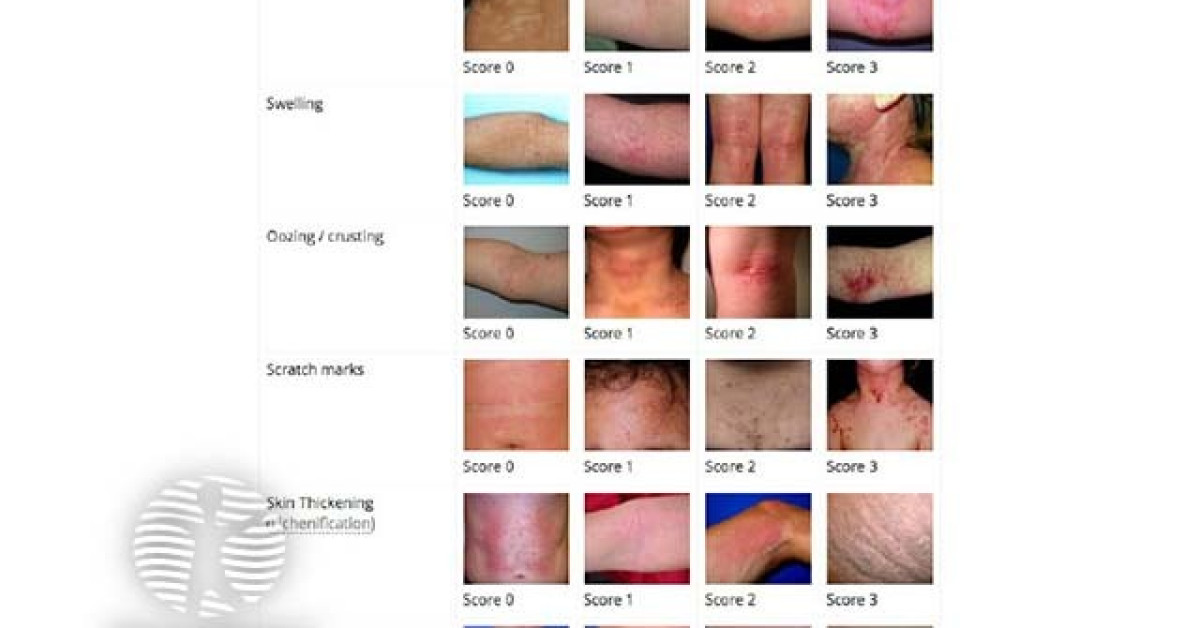 SCORAD intensity scores image
