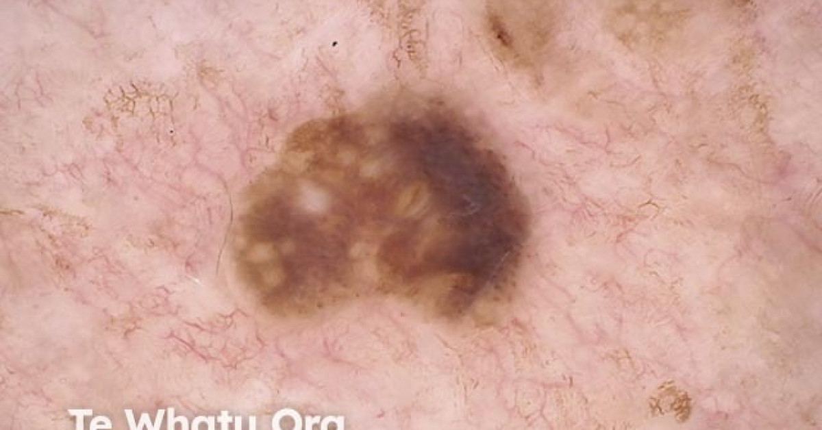 Seborrhoeic keratosis, polarised dermoscopy view image