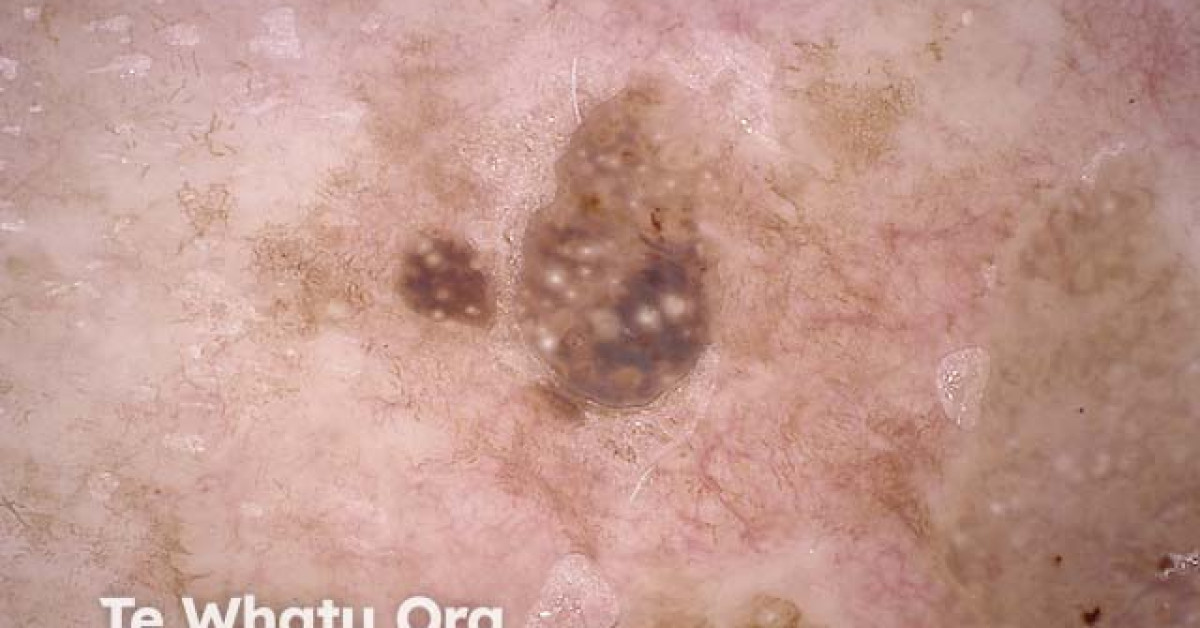 Seborrhoeic keratosis, nonpolarised dermoscopy view image