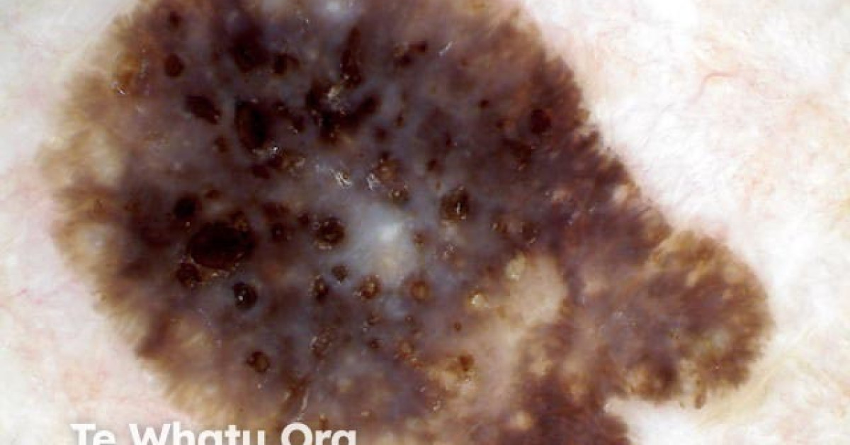 Seborrhoeic keratosis, polarised dermoscopy view image