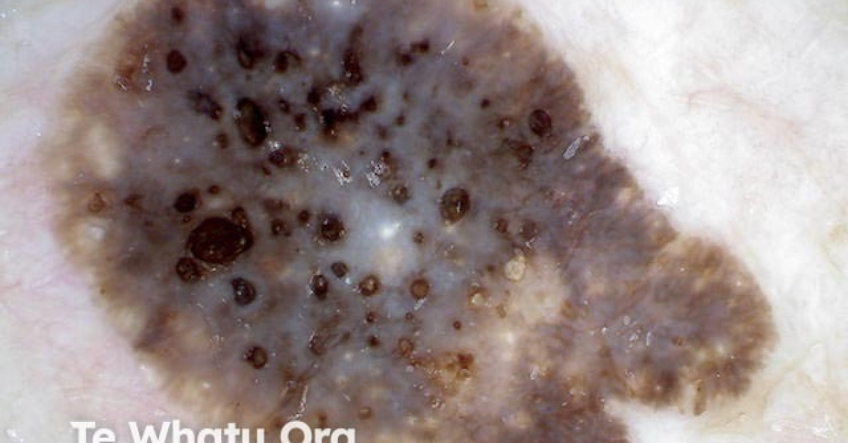 Seborrhoeic keratosis, nonpolarised dermoscopy view image