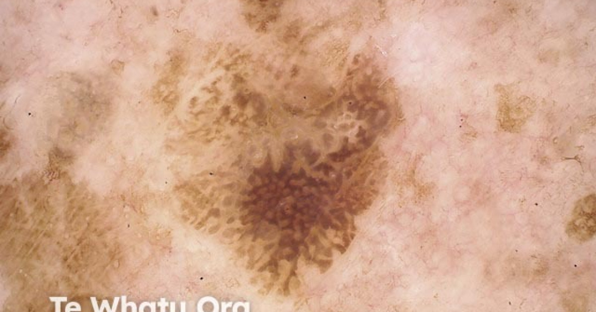 Seborrhoeic keratosis, polarised dermoscopy view image
