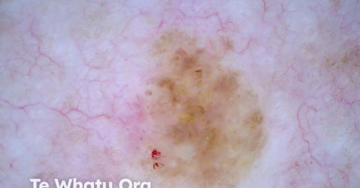 Seborrhoeic keratosis, polarised dermoscopy view image