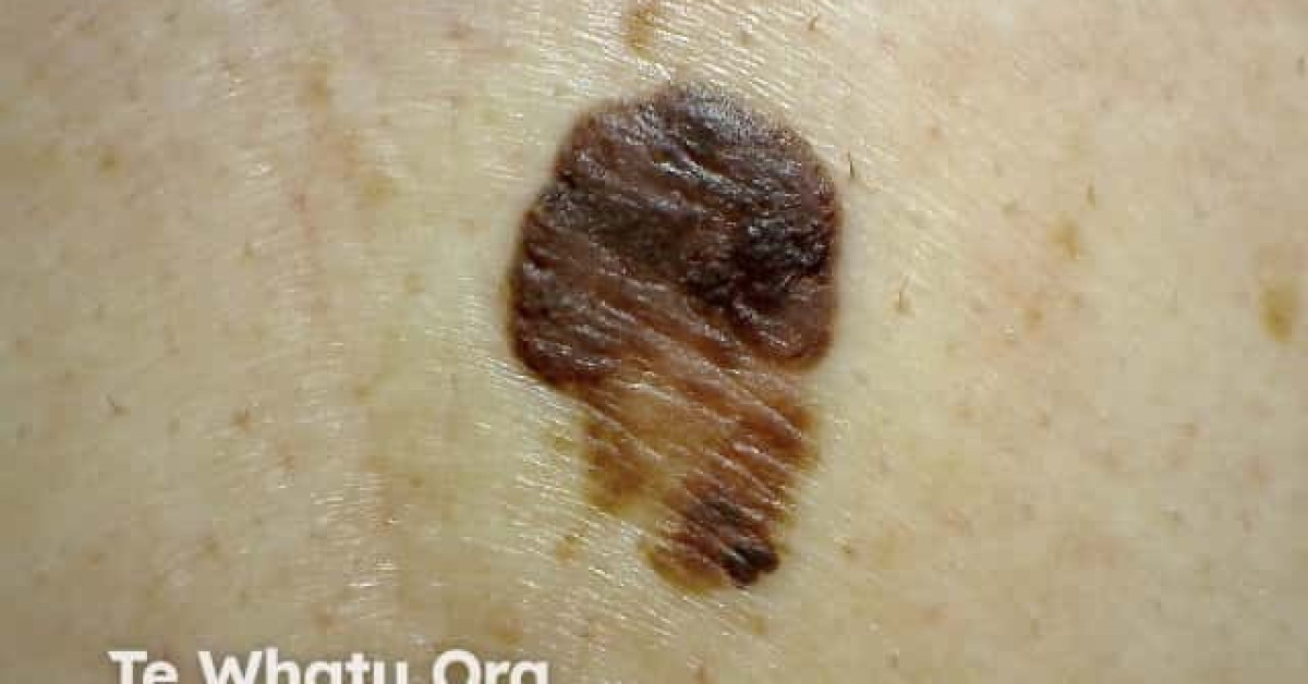 Seborrhoeic keratosis image