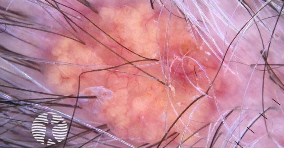 Sebaceous carcinoma dermoscopy image