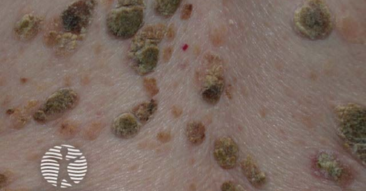 Seborrhoeic keratoses image