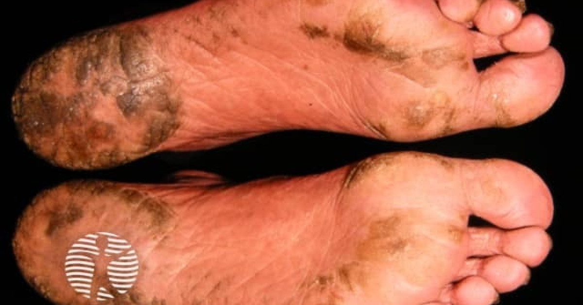 Plantar Keratoderma In Sezary Syndrome Image