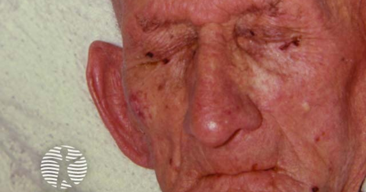 Sezary Syndrome image