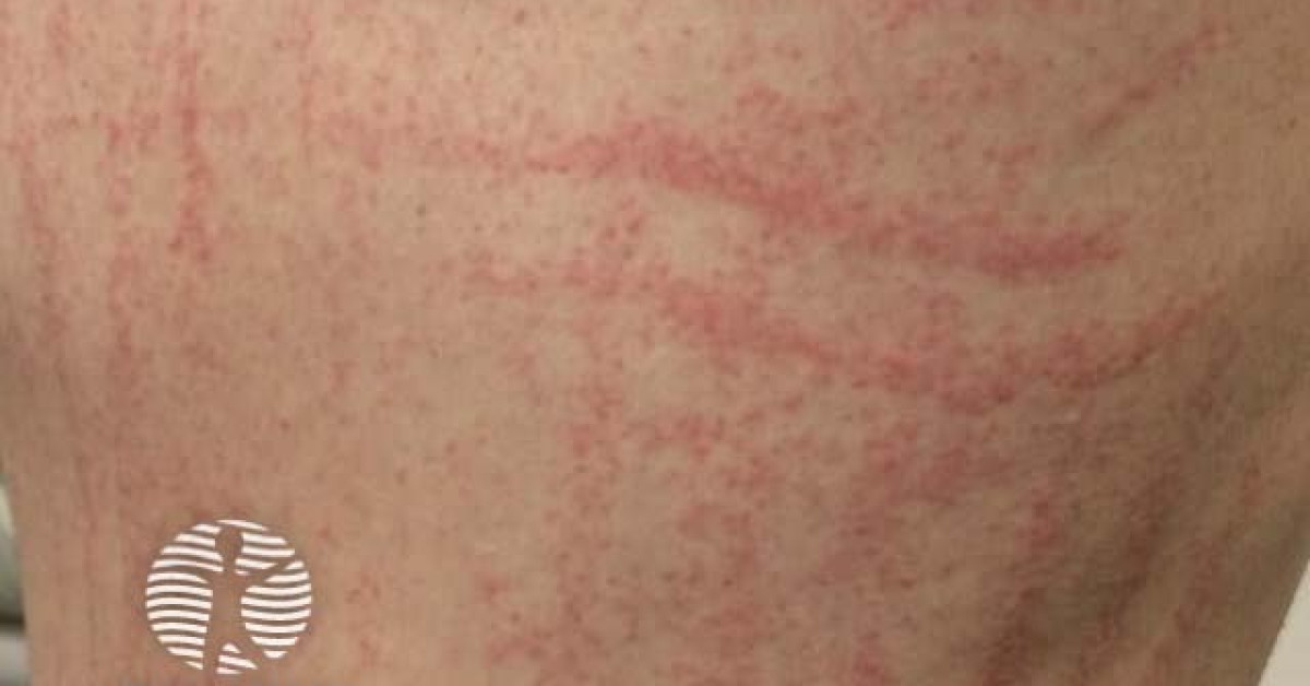 Shiitake flagellate erythema image