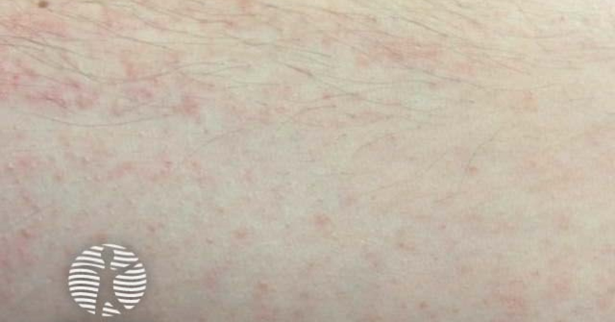 Shiitake flagellate erythema image