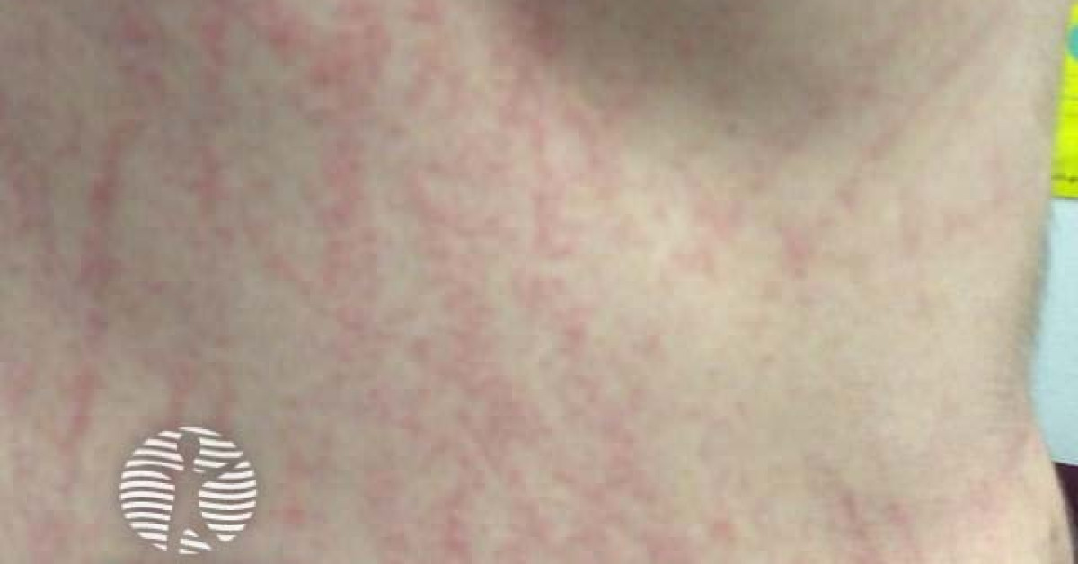 Shiitake flagellate erythema image