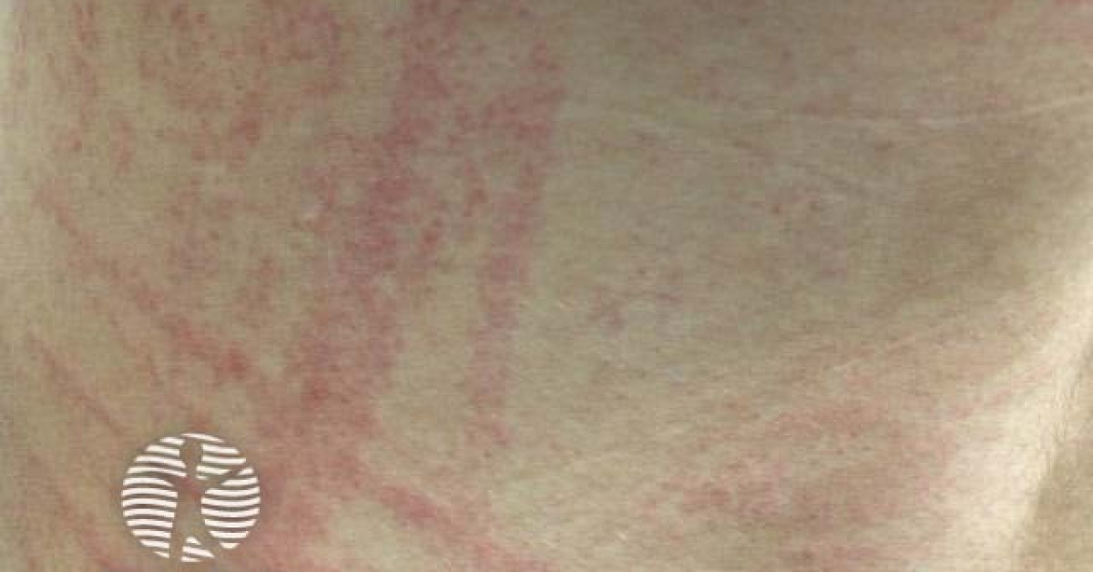 Shiitake flagellate erythema image