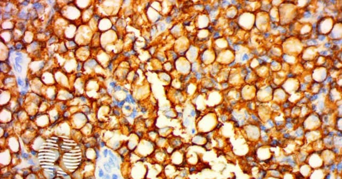 `Signet ring lymphoma pathology stained with CD20 x400 image