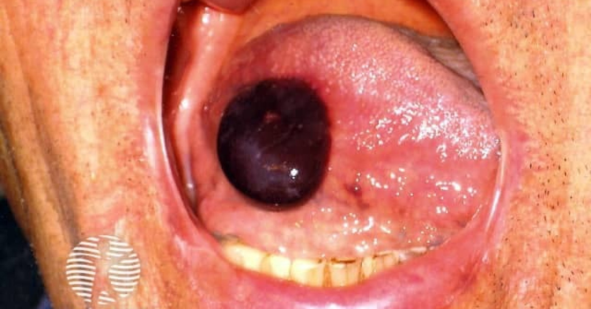 Angina bullosa haemorrhagica image
