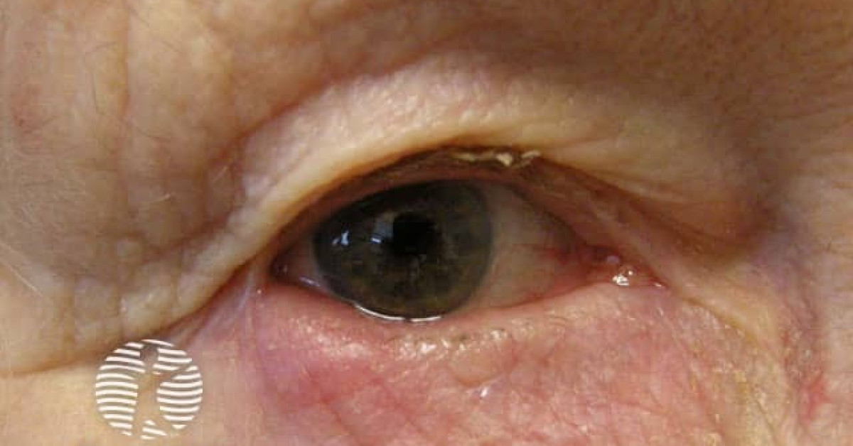 Blepharitis image