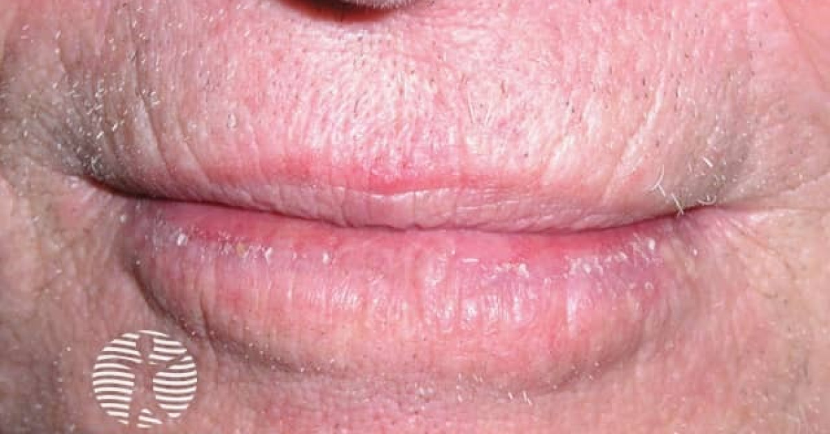 Actinic cheilitis image