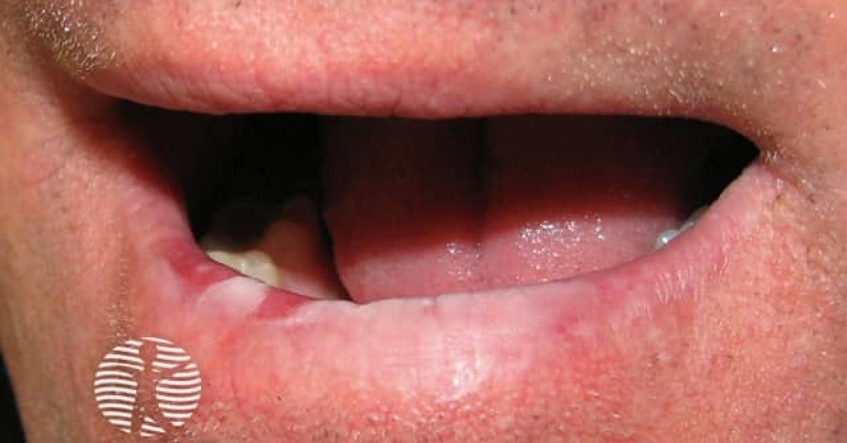 Actinic cheilitis image