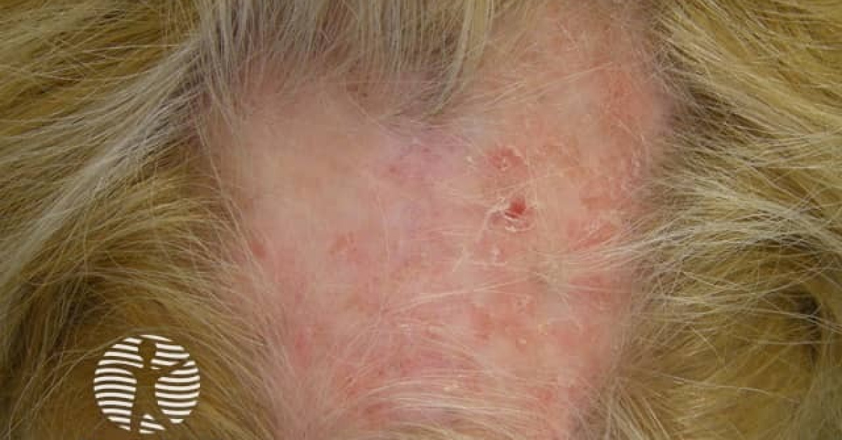 Discoid lupus erythematosus of scalp image