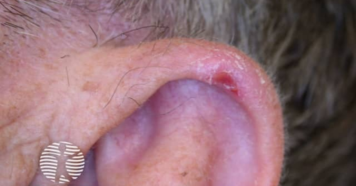 Ulcerated chondrodermatitis nodularis helicis image