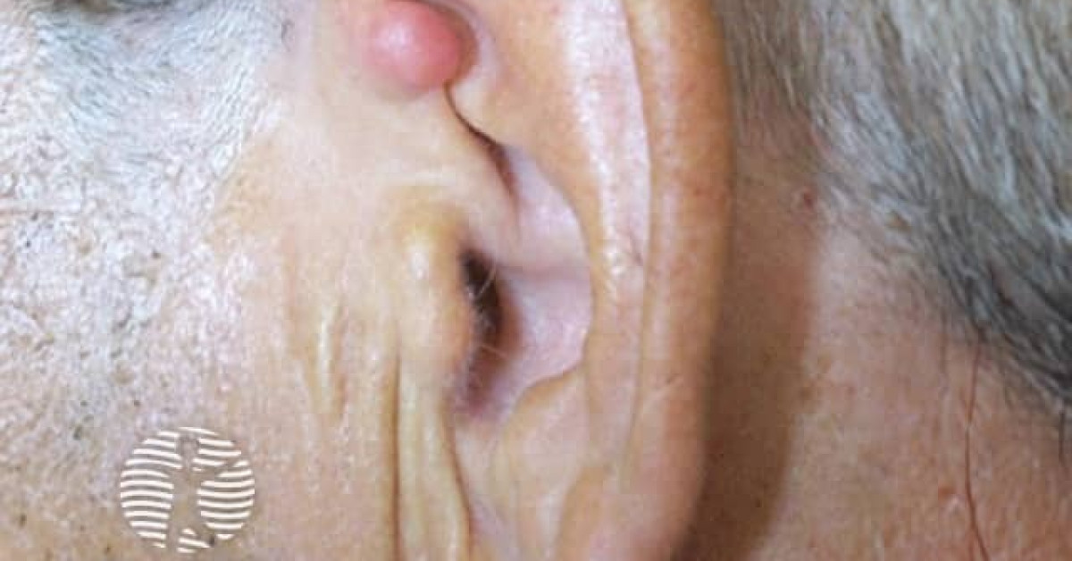 Dermal naevus image