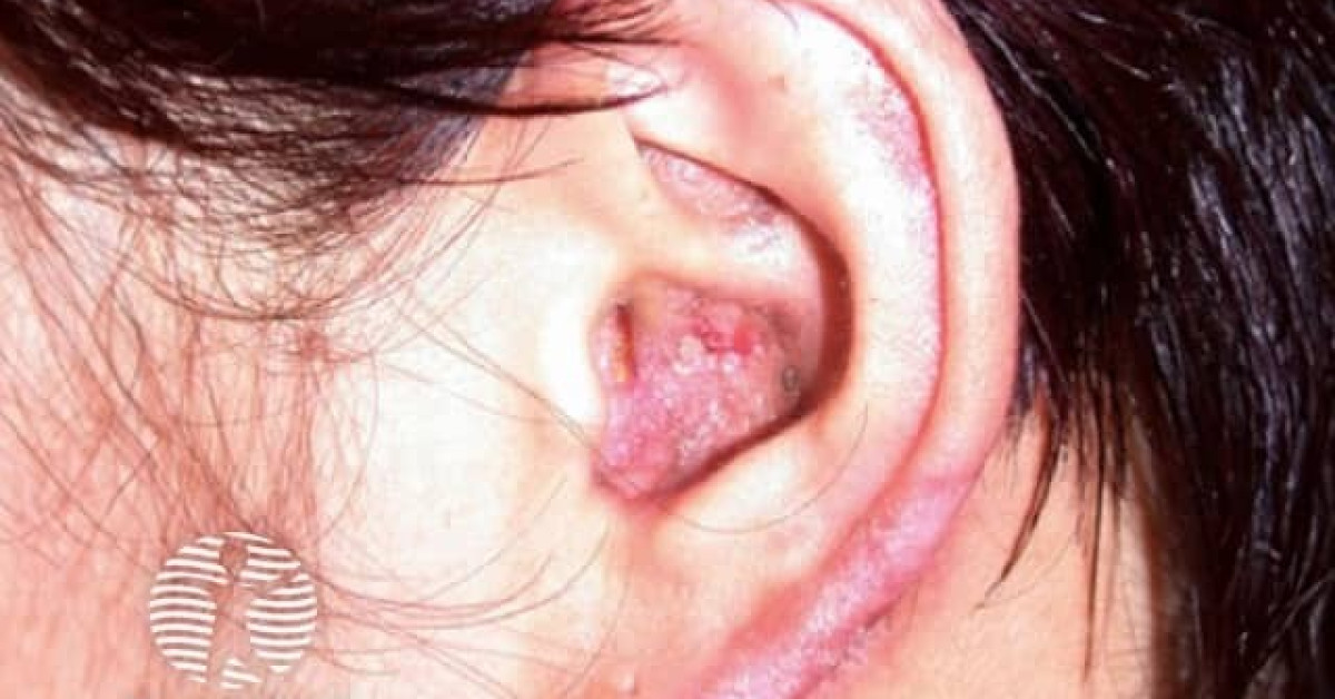 Discoid lupus image