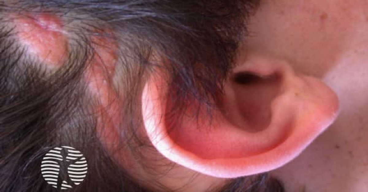 Epidermal sebaceous naevus image