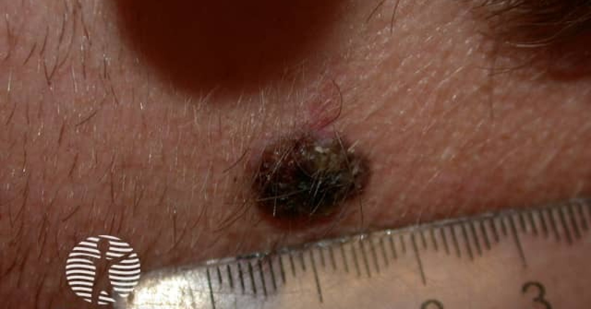Nodular melanoma image