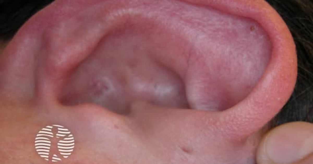 Preauricular sinus image