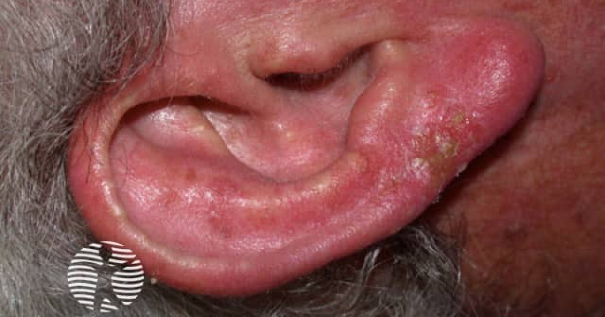 Squamous cell carcinoma illdefined image
