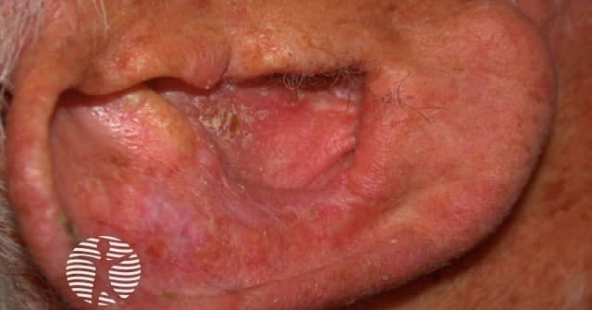 Squamous cell carcinoma in situ image