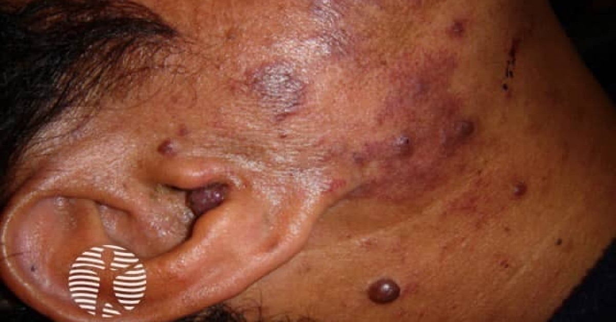 Vascular malformation image