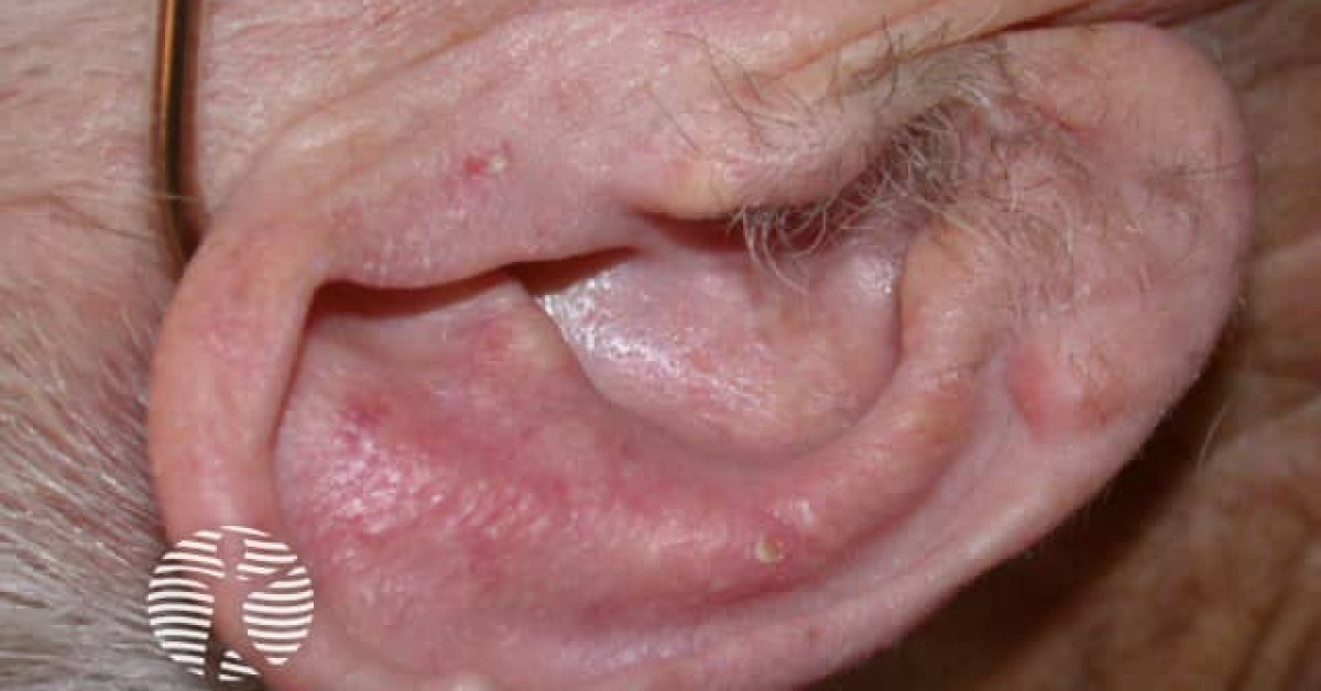 Weathering nodule image