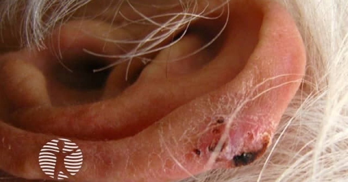 Well diferentiated squamous cell carcinoma image