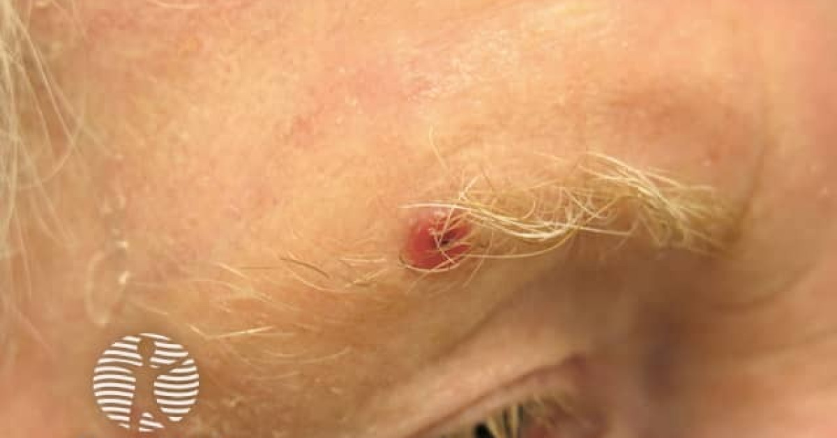 Eyelid atypical fibroxanthoma image