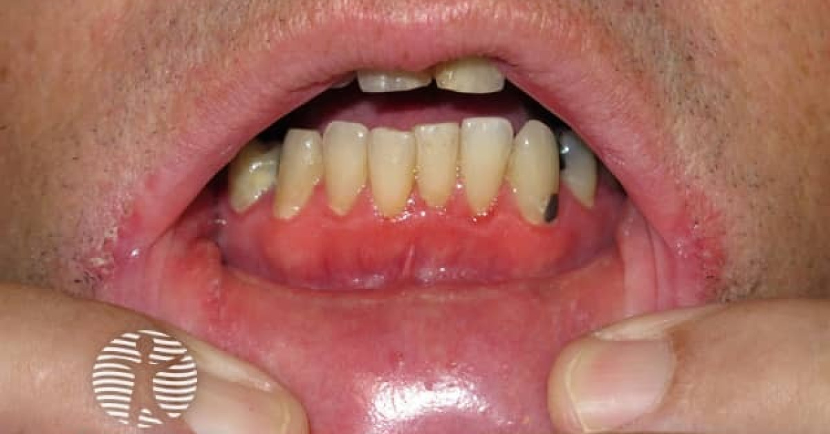 Gingivitis image