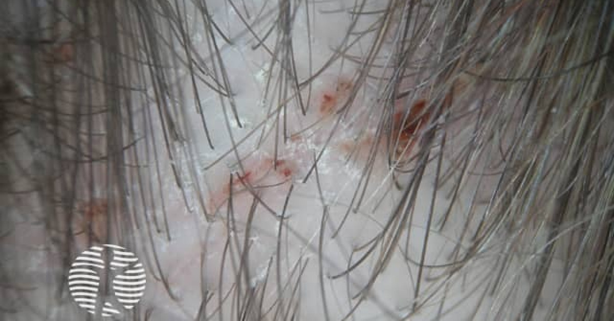 Head lice image