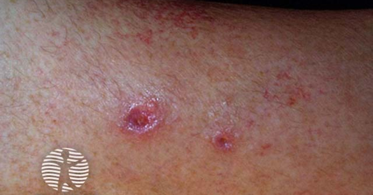 Leg ulcer image